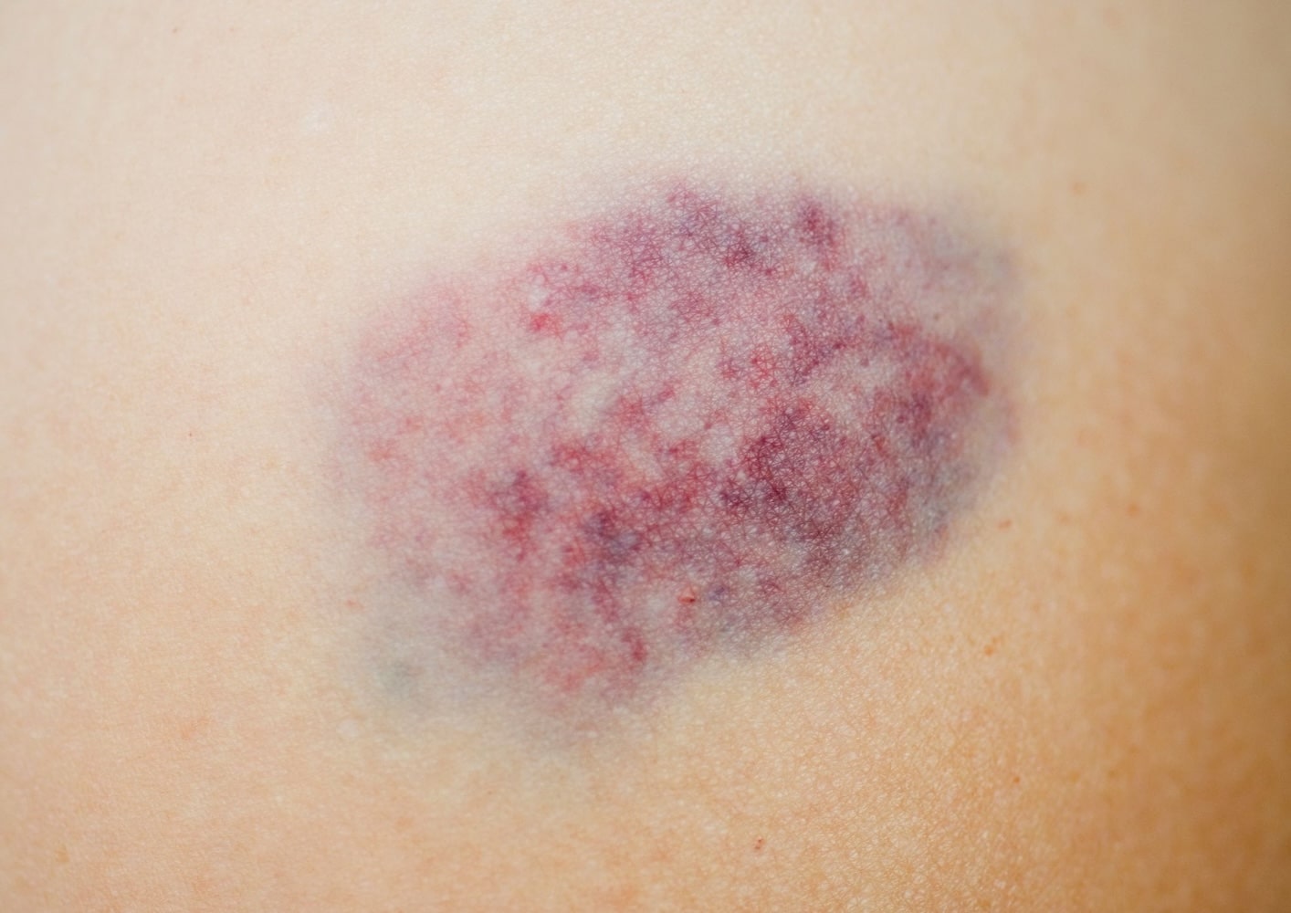 Liver Cirrhosis Treatment - Dr Thng Yongxian