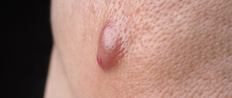 Should I Get My Sebaceous Cyst Removed?